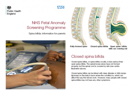 New spina bifida and anencephaly information leaflets for parents ...