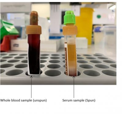 Blood sample quality in fetal anomaly screening – PHE Screening